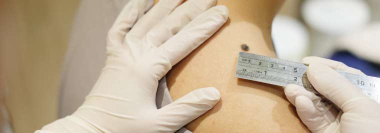 Electrocauter - C Derma - Dermatology & Aesthetic Center