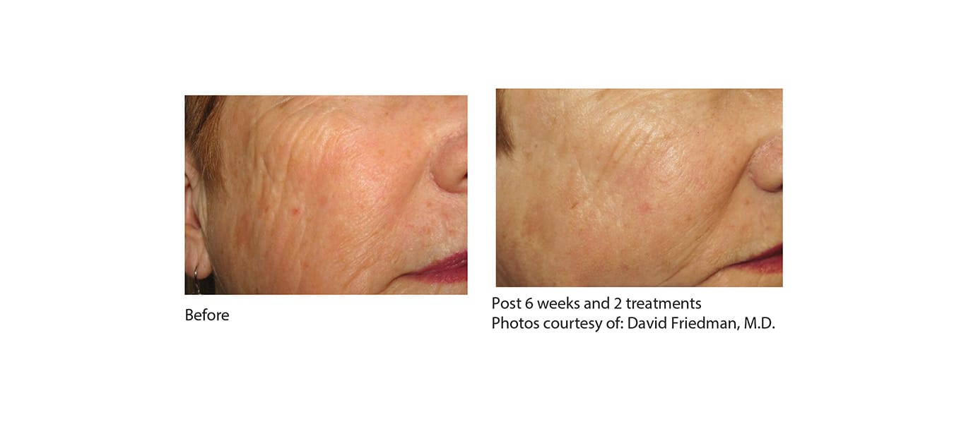 Perawatan Laser PicoWay Keunggulan Terbaru untuk Kulit Glowing